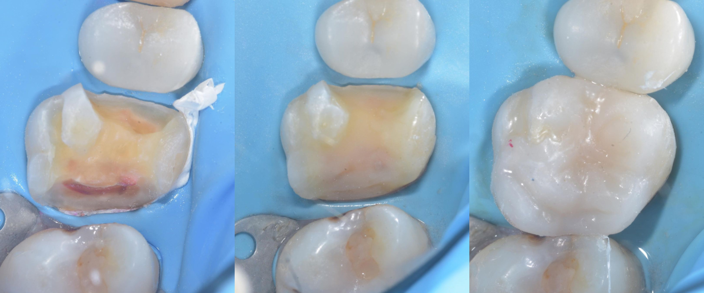 Lesson 5 - Enamel Replacement (Enamel Preparation and Adhesive ...