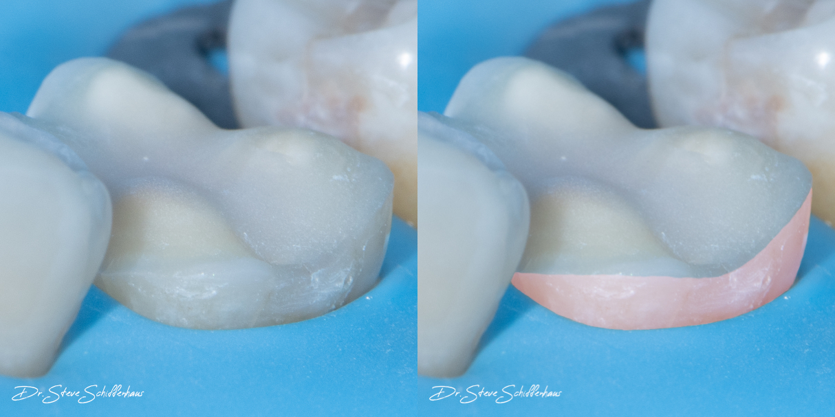 Lesson 5 - Enamel Replacement (Enamel Preparation and Adhesive ...