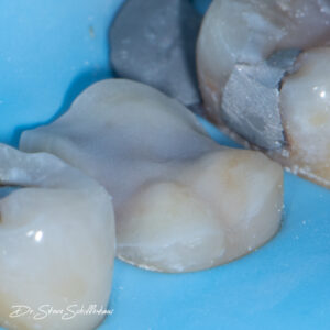 Lesson 5 - Enamel Replacement (Enamel Preparation and Adhesive ...