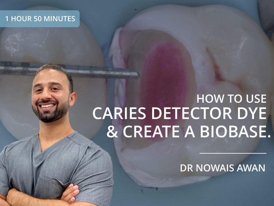 How to Use Caries Detector Dye and Create a Biobase - Dr Nowais Awan ...